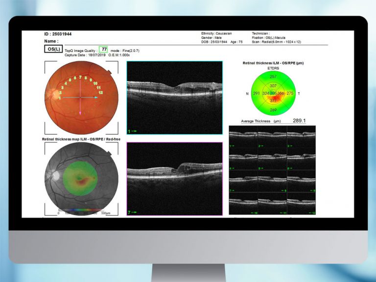 Retinopatia diabetica - Studio Oculistico Mauceri